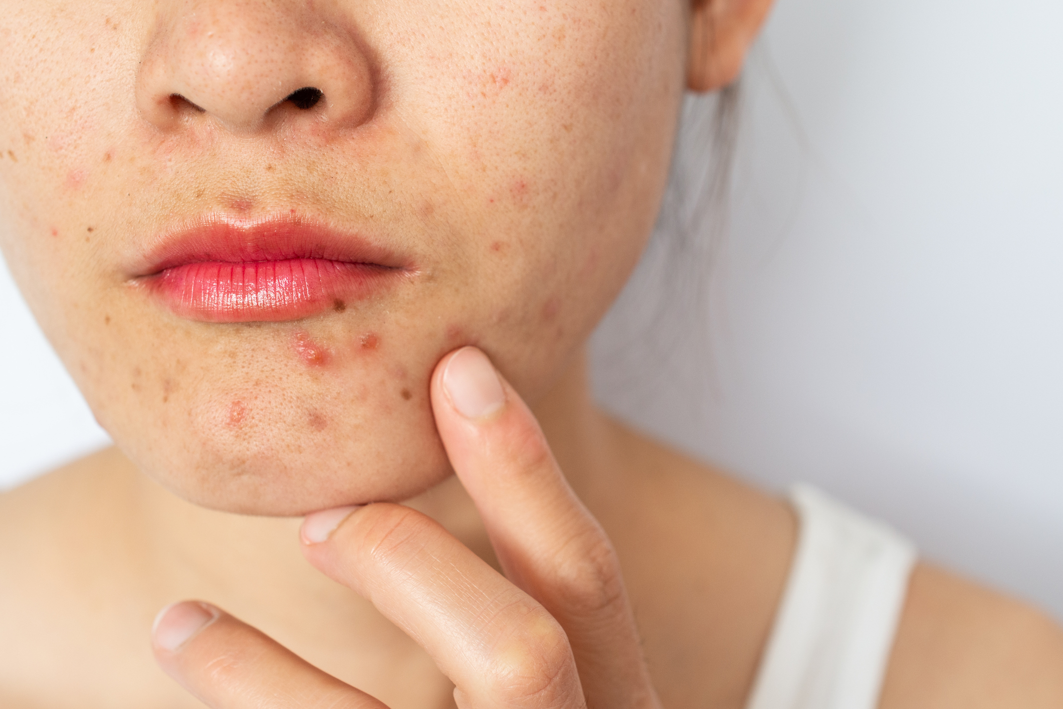 Acne: O que é, Causas, Sintomas, Tratamento e mais | mybest